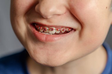 Emergency Traditional Braces Repair: Quick Fixes for Brackets and Wires ...